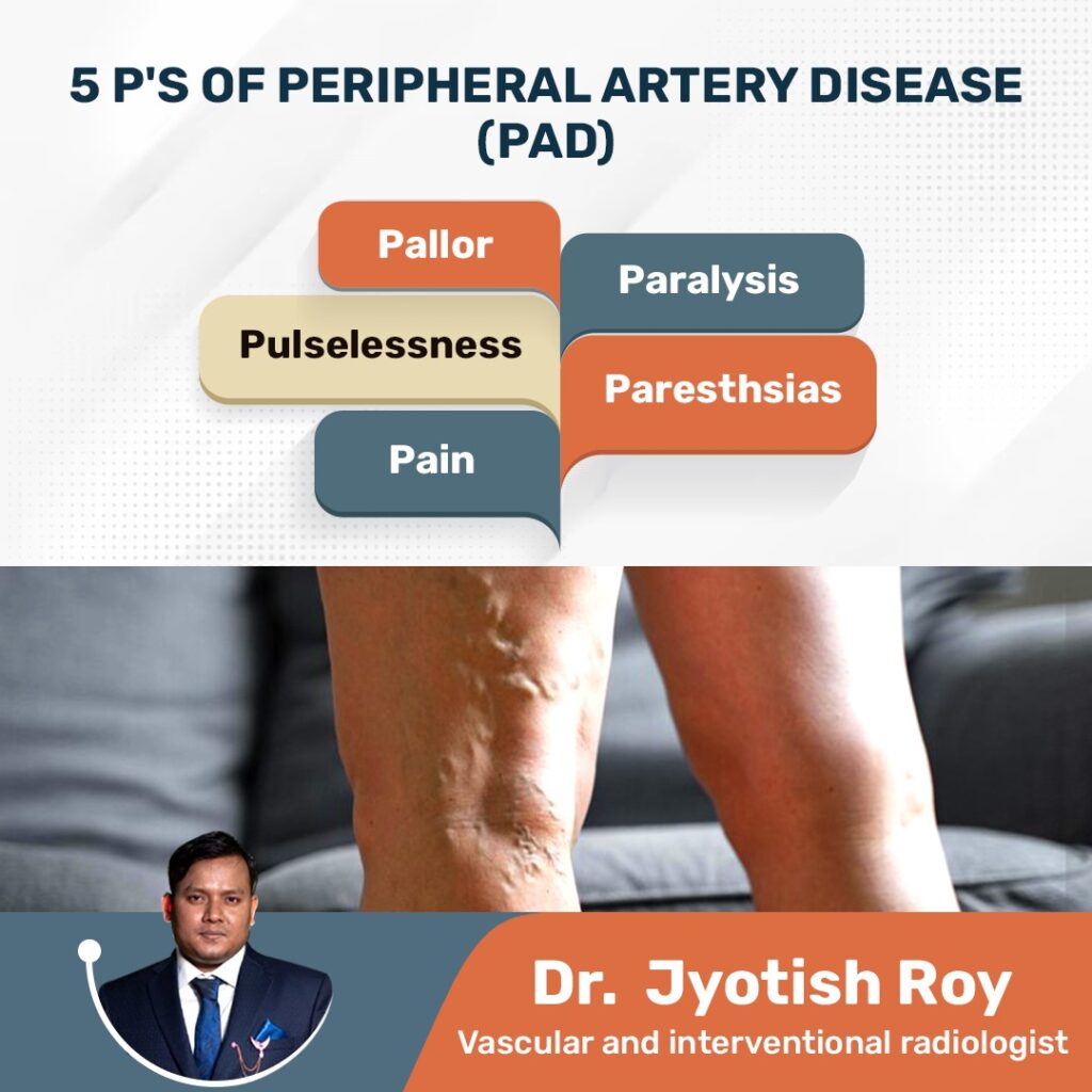 Understanding Peripheral Artery Disease (PAD) and Its Treatments – Dr ...